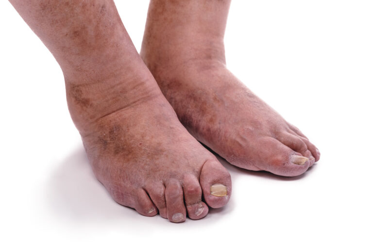 The Guide to Gout and What You Can do About it - Hillandale Primary Care